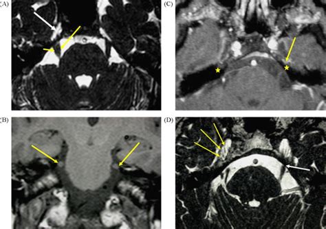 Imaging The Trigeminal Nerve European Journal Of Radiology