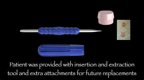 Maxillary Tooth Supported Overdenture With Mandibular Cast Partial Denture Myzerodonto