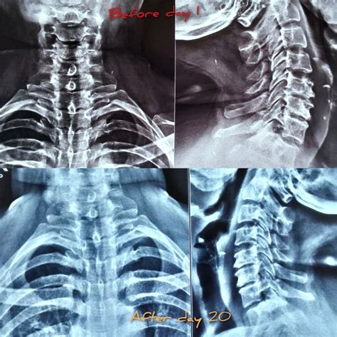 Dr Subrat Kumar Barik On Linkedin Here We Can See The Difference In The X Ray How The Alignment