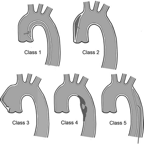 Pathophysiology Of Aortic Dissection And Connective T Vrogue Co