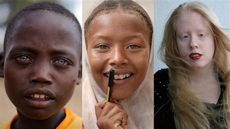 5 Types Of Albinos And How They Look Pulse Nigeria