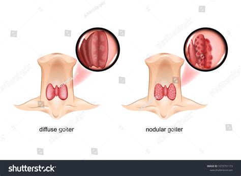 Vector Illustration Diffuse Nodular Goiter Thyroid Stock Vector Royalty Free 1073751173