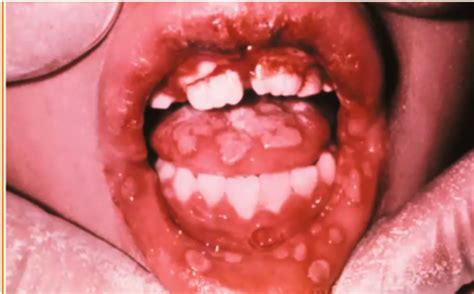 Viral Infections Flashcards Quizlet