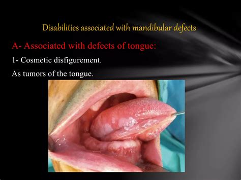 Mandibular Defects Maxillofacial Prosthesis Pptx