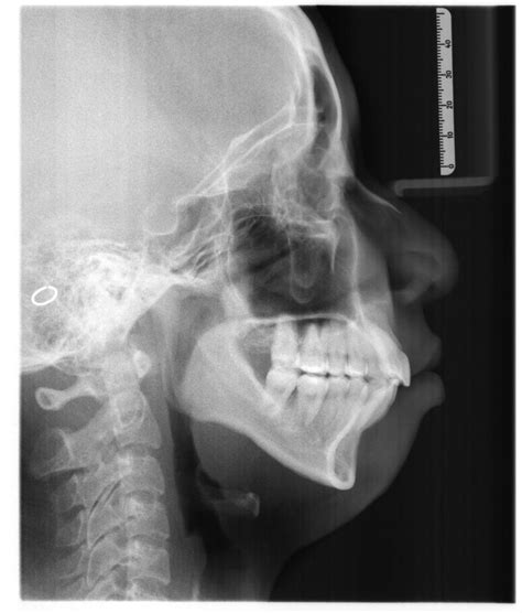 Discover More Like Braces My Bite Is A Skeletal Problem Sigh