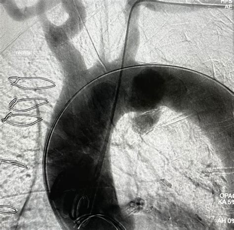 Double In Situ Fenestration For Left Cca And Lsa With The Ankura Bridged With Vbx For An Aortic