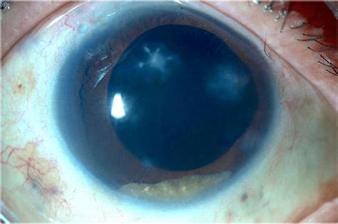 slit lamp photograph using diffuse illumination of the right eye