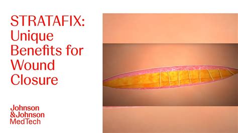 stratafix spiral bidirectional regular and dual layer closure