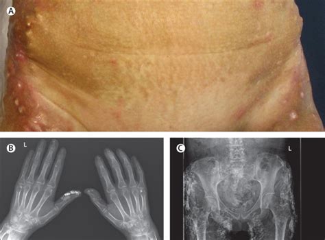 Scleroderma Hands Xray