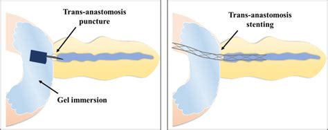 Eus Guided Pancreaticojejunostomy Under Gel Immersion For Pancreaticojejunal Anastomotic