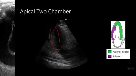 Point Of Care Echo Regional Wall Motion Abnormalities Youtube Point Of Care Echo Regional Wall Motion Abnormalities Youtube