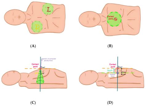 a yellow r represents the right electrode location red l represents