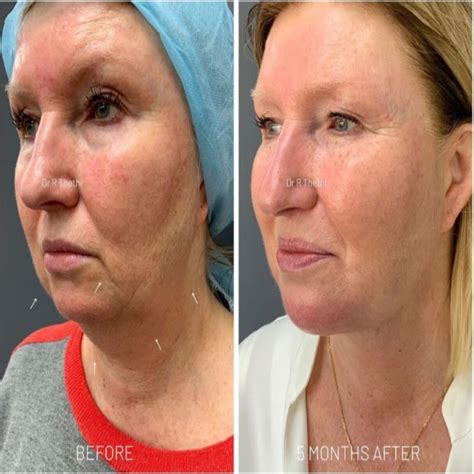 Anti Wrinkle Injections Before And After Photos Ysc