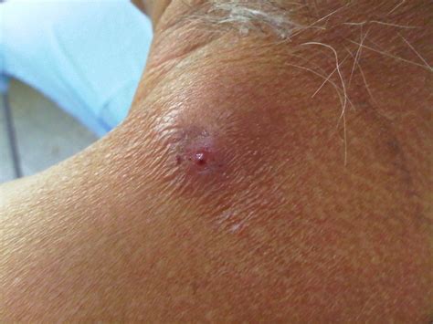 What Is Myiasis Know Symptoms Causes Treatment