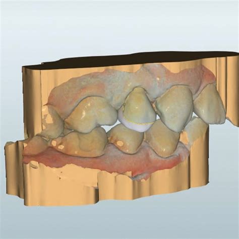 Cad Cam Fabricated Endodontic Crown Made From The Vita Enamic Multicolor Hybrid Ceramic
