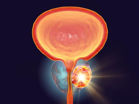 Comparison Of Androgen Receptor Inhibitors For Nonmetastatic Castration