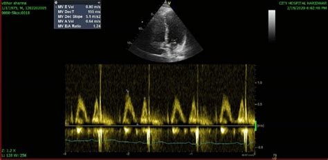 Normal Mitral Inflow Pattern E A E Early Inflow Wave A Atrial Download Scientific Diagram