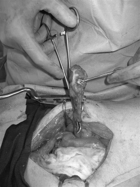 Photograph Taken During The Operation Revealing 2 Perforations Of A Download Scientific Diagram
