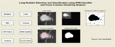 Figure 1 From Analysis Of Lung Nodule And Classification Based On Svm