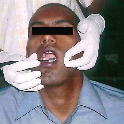 Averaged Fluorescence Excitation Spectra Of Normal Betel Quid Chewers Download Scientific