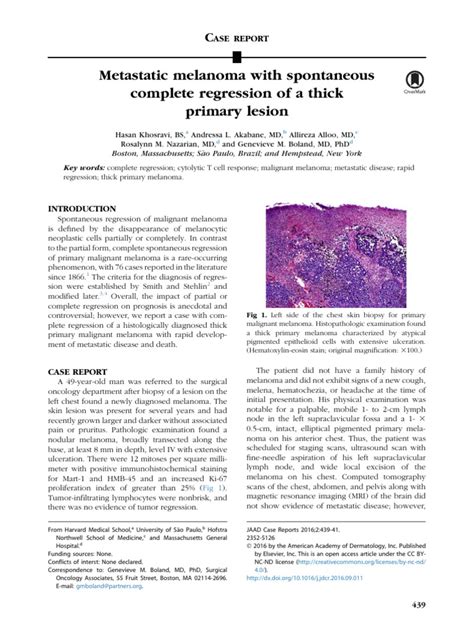 Metastatic Melanoma With Spontaneous Complete Regression Of A Thick Primary Lesion Pdf