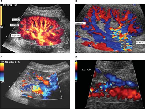 Intrarenal Color Duplex Ultrasonography Gao 2007 Journal Of