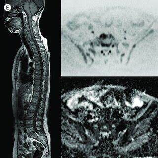 Patterns Of Marrow Infiltration In Multiple Myeloma Continued A E Download Scientific