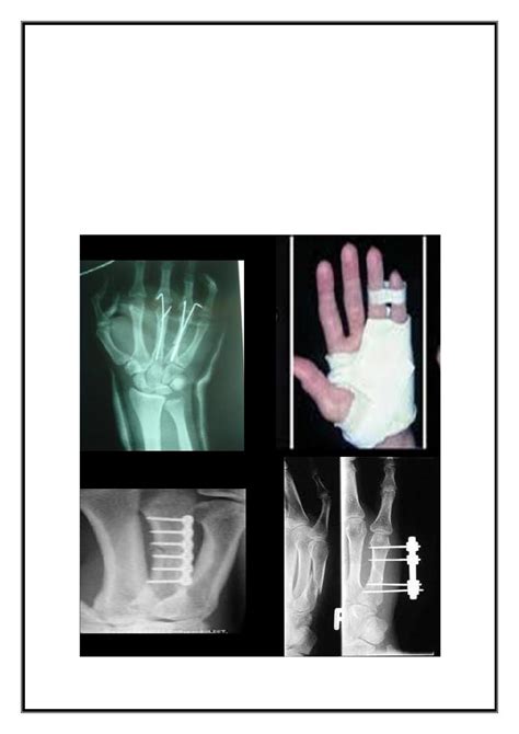 Metacarpal And Phalangeal Fractures Pdf D Khalid Muhadharaty