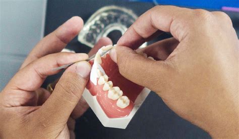 Composite Injection Moulding Veneers Medimatch Dental Laboratory