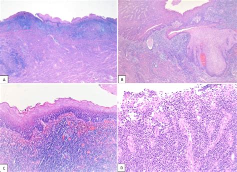 A Hande 20x Section Of Endomyometrium Demonstrating Replacement Of Download Scientific Diagram