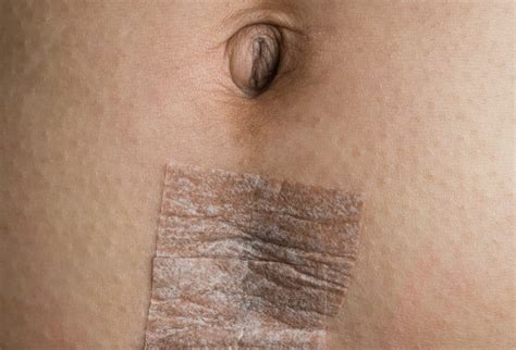 C Section Incision Before And After