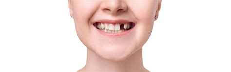 Complete Your Smile Top Solutions For Replacing A Missing Tooth