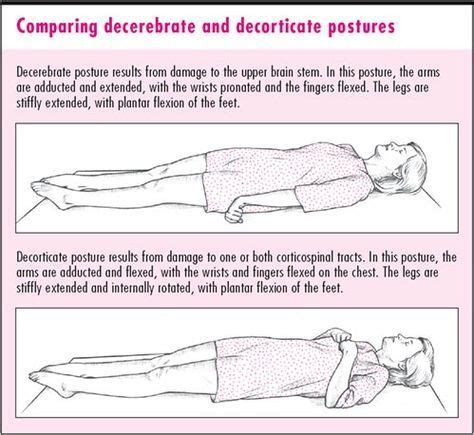 Decelerations Nursing Decerebrate Vs Decorticate Chest Physiotherapy