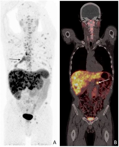 Nuclear Imaging Of Neuroendocrine Tumors Pmc