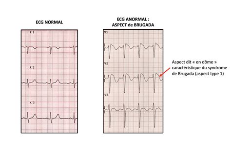 Syndrome De Brugada Ecg Risques Et Prise En Charge Rythmopôle