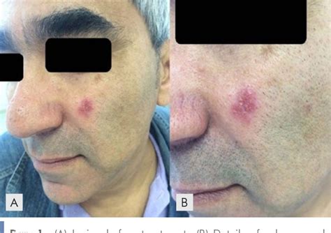 Figure 1 From Lupus Vulgaris A Diagnostic Challenge Semantic Scholar