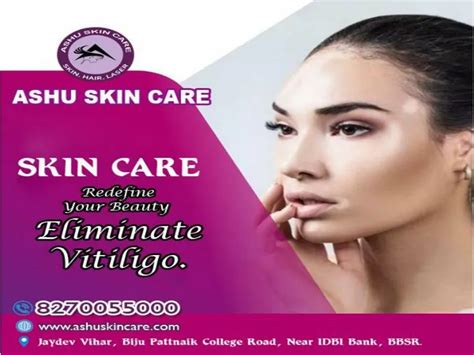 Ppt Ashu Skin Care Is Best For Vitiligo Treatment In Bhubaneswar Odisha Powerpoint