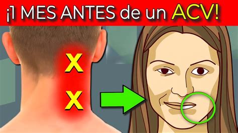 7 SeÑales De Advertencia 1 Mes Antes De Un Acv Ictus Cerebral Youtube