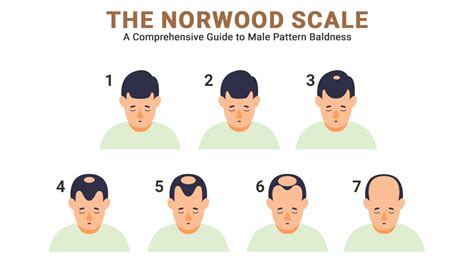 7 Stages Of The Norwood Scale Causes Of Male Pattern Baldness