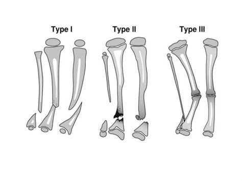 Pseudoarthrosis Tibia Pptx