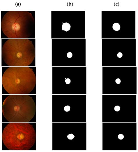 Optic Disc Segmentation In Human Retina Images Using A Meta Heuristic Optimization Method And