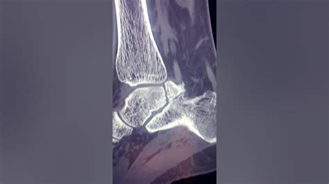 Os Trigonum Syndrome Very Large Os W Severe Oa At The Synchondrosis
