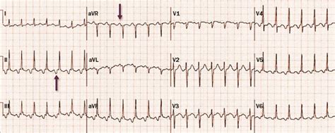 Differential Diagnosis Of Svt Ecg Book