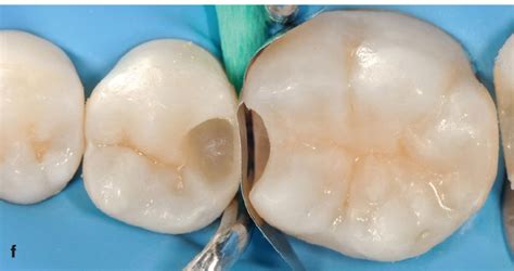 Restoring The Interproximal Wall Pocket Dentistry