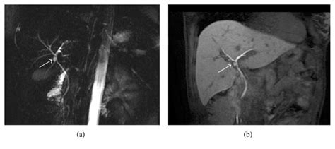 Contrast Enhanced Magnetic Resonance Cholangiography Practical Tips And Clinical Indications