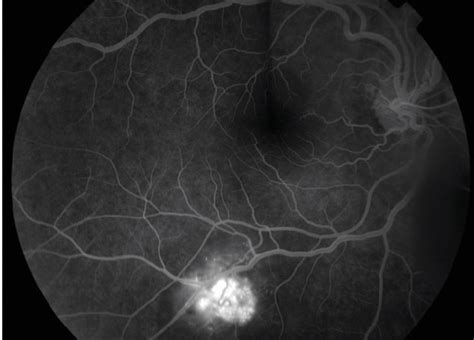 Pheno And Genotype Presentations And Ocular Treatment Outcomes Of Von