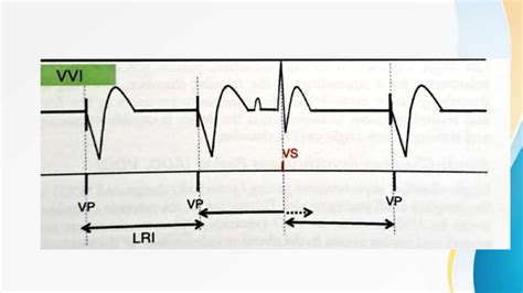 Permanent Pacemaker Cycle Length Managent Ppt Free Download