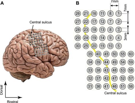 Electrodes Placed On The Sensorimotor Cortex Of Patient Open I