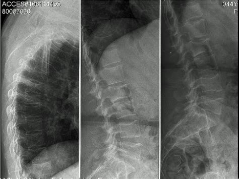 Dorso Lumbosacral Spine X Ray Fracture Deformities Of D 7and Of The