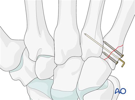 Orif For Dislocation And Fracture Dislocation Of The Carpometacarpal Joint